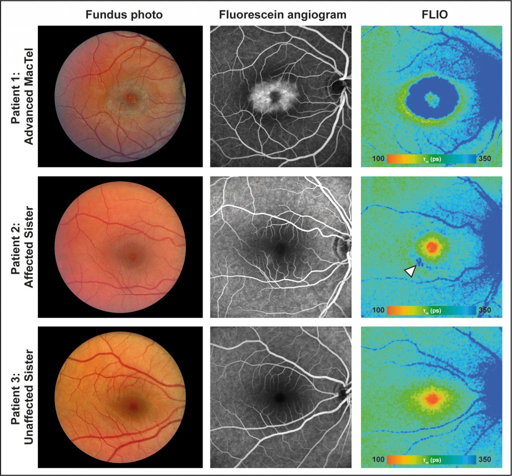 Genetic discovery in rare eye disease – @theU